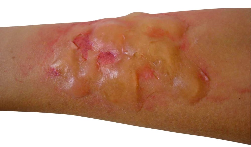 Prothèse brûlure grave – Simulation réaliste pour formations secourisme